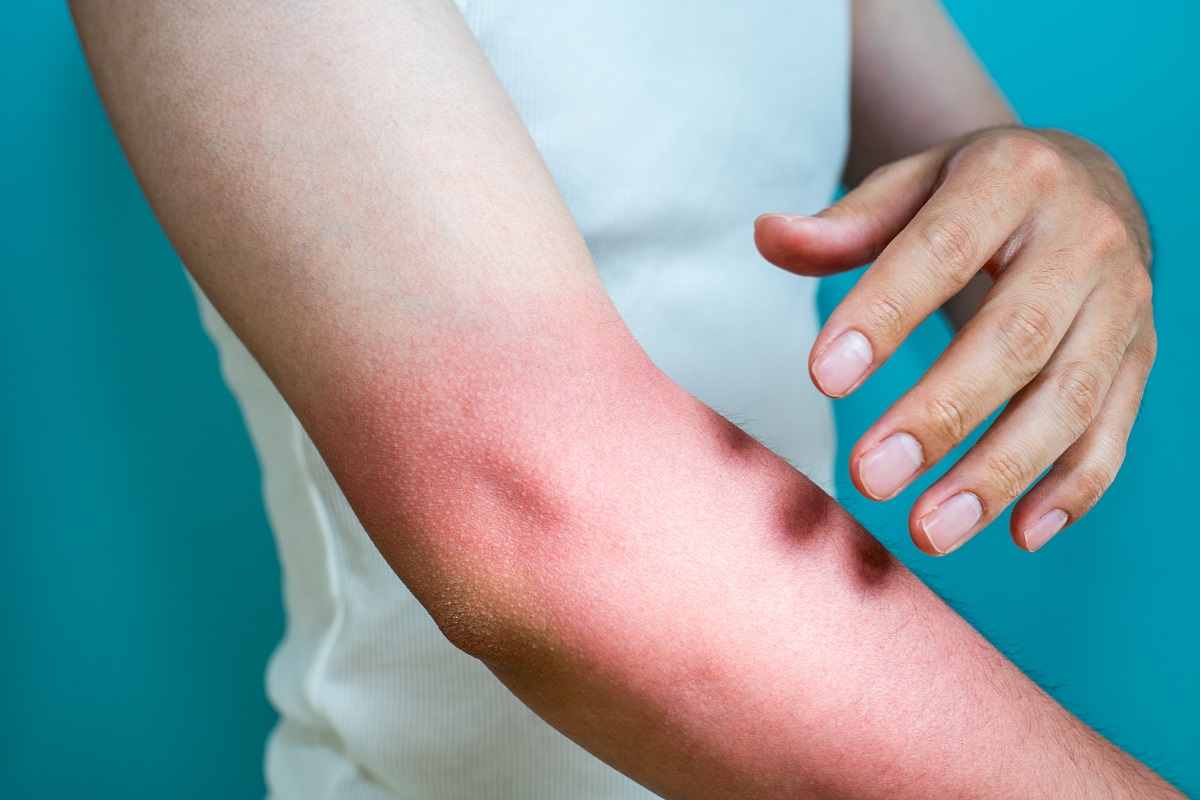 Know The Parts Of Your Body Prone To Sun Damage | Redsave
